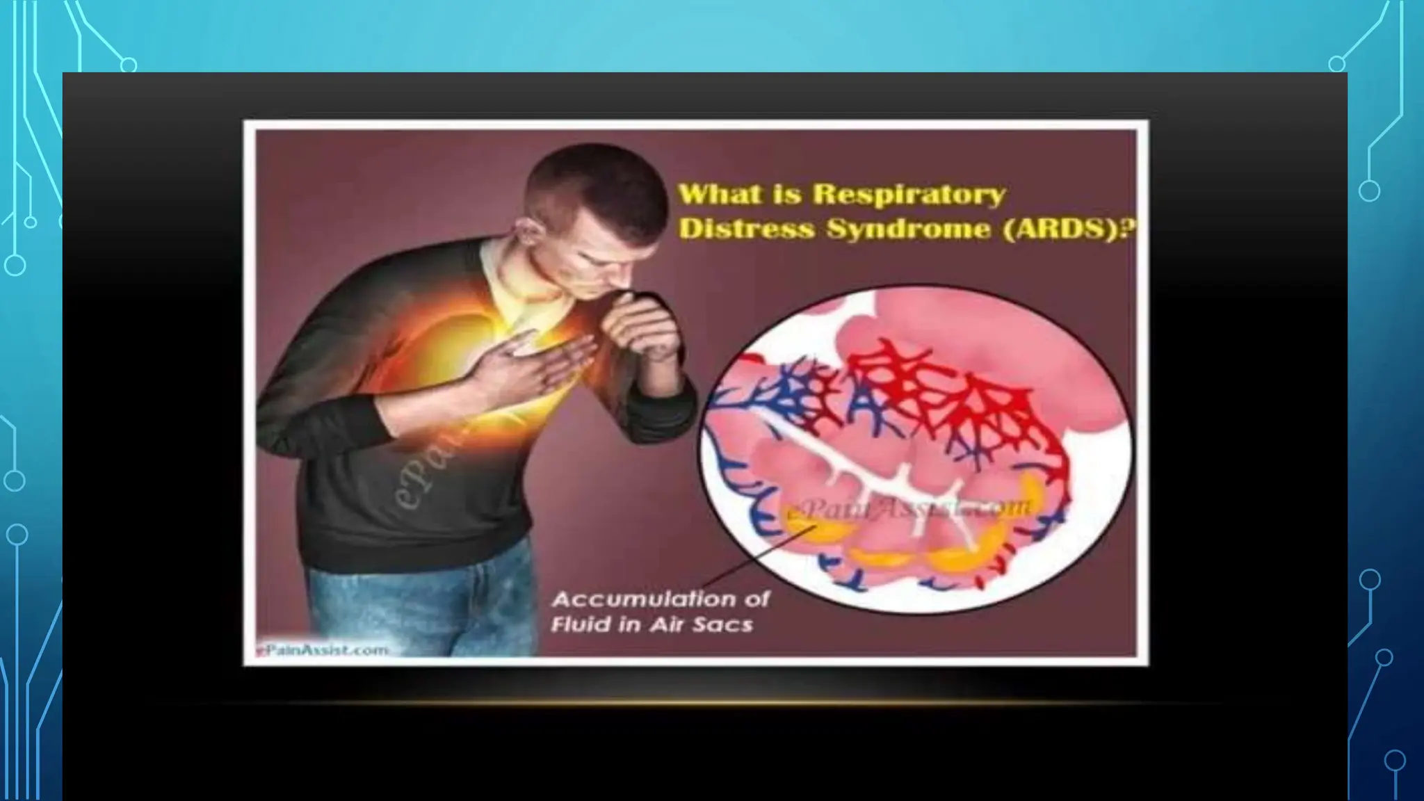 ARDs and lung cancer acute respiratory distress syndrome | PPTX