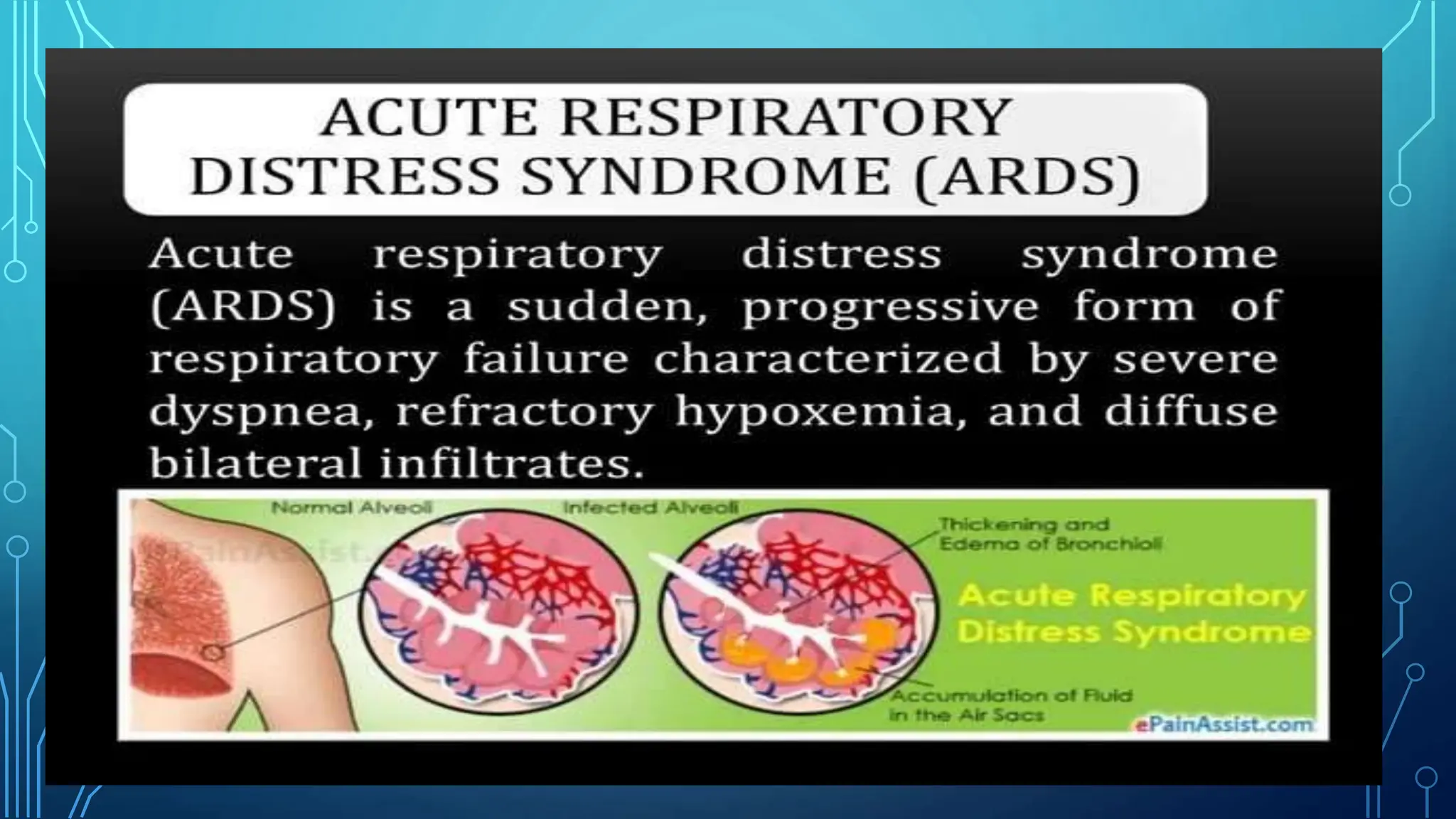 ARDs and lung cancer acute respiratory distress syndrome | PPTX