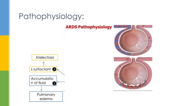 ARDS (Case study) | PPTX | Lung and Respiratory Health | Diseases and Conditions