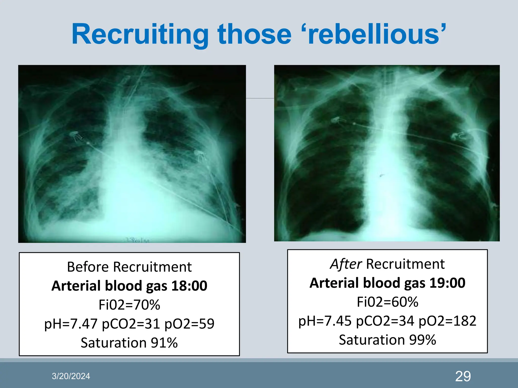 Acute respiratory distress syndrome ARDS.pptx