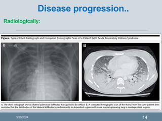 Acute respiratory distress syndrome ARDS.pptx
