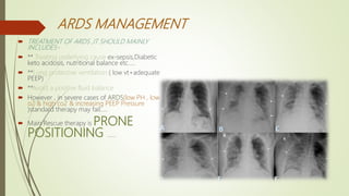 ARDS MEANING,MANAGEMENT . PRONE POSITIONING & NURSES ROLE | PPTX