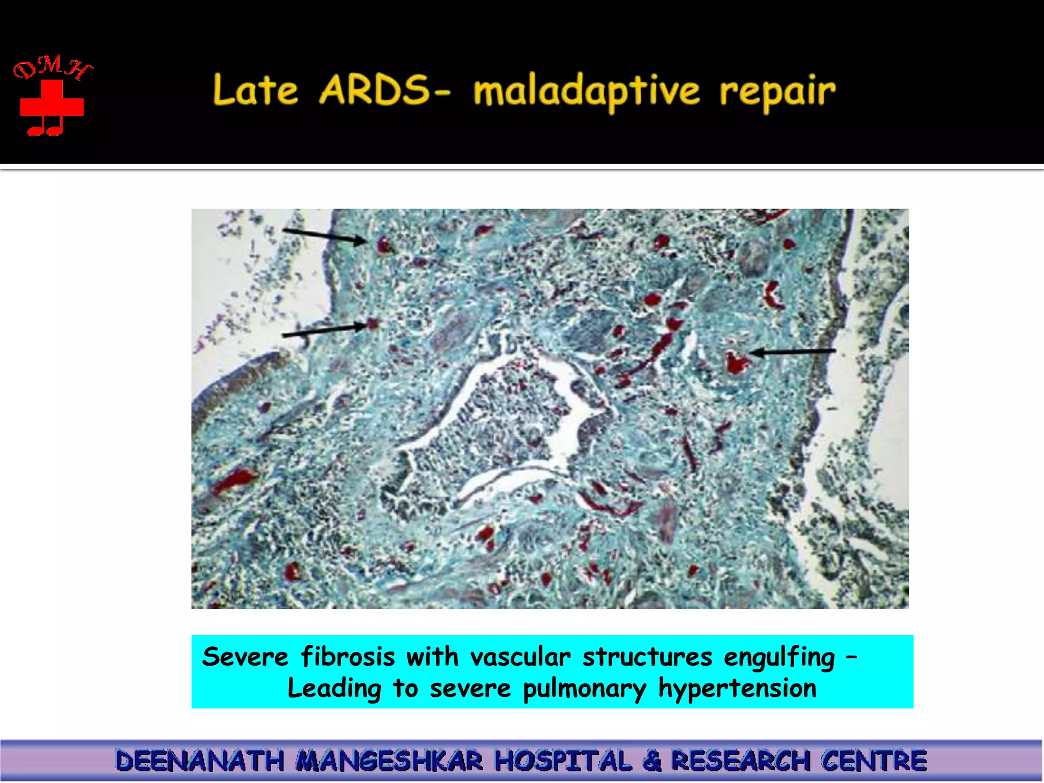 ARDS PATHO PHYSIOLOGY 1.pptx