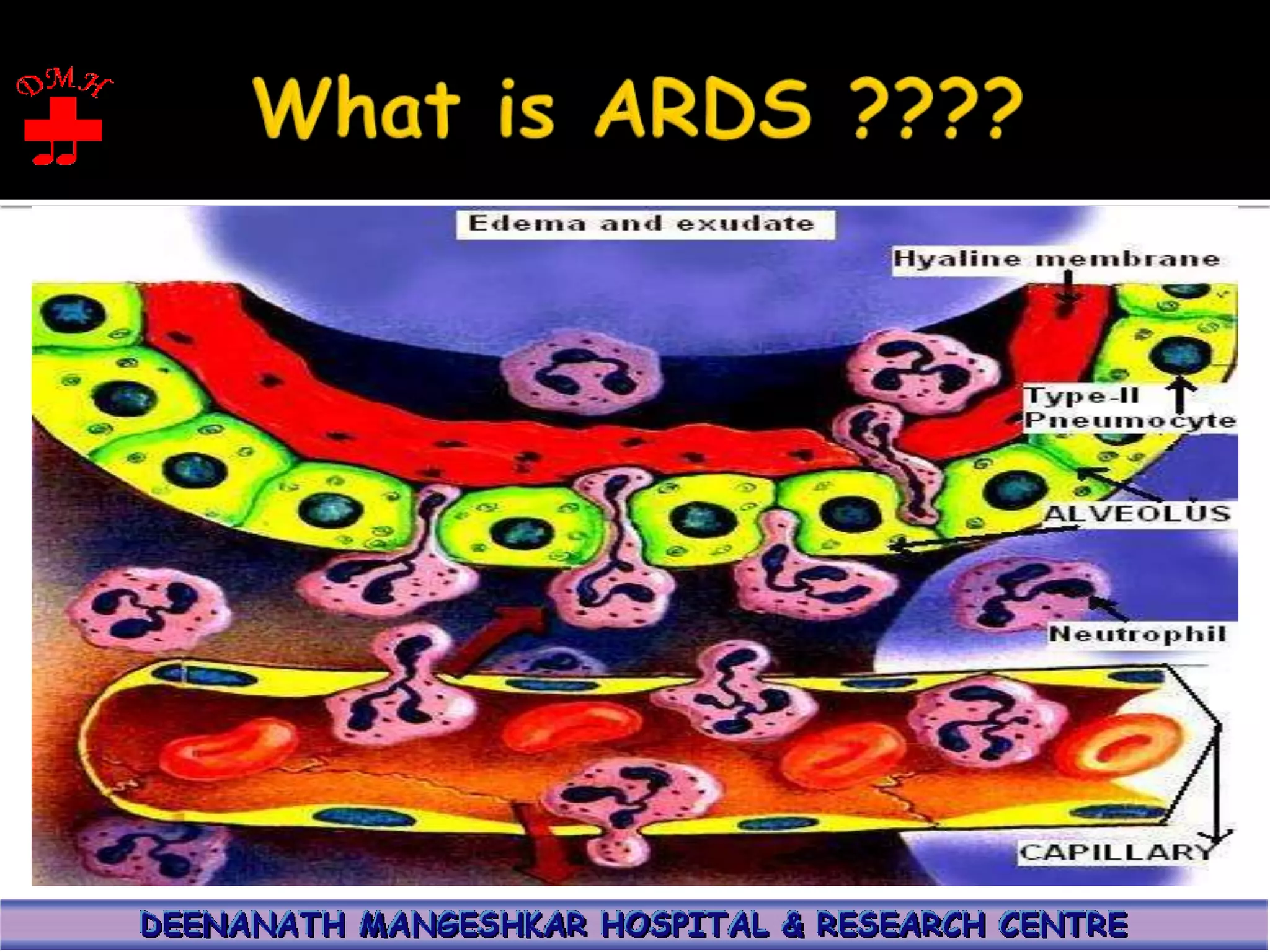 ARDS PATHO PHYSIOLOGY 1.pptx