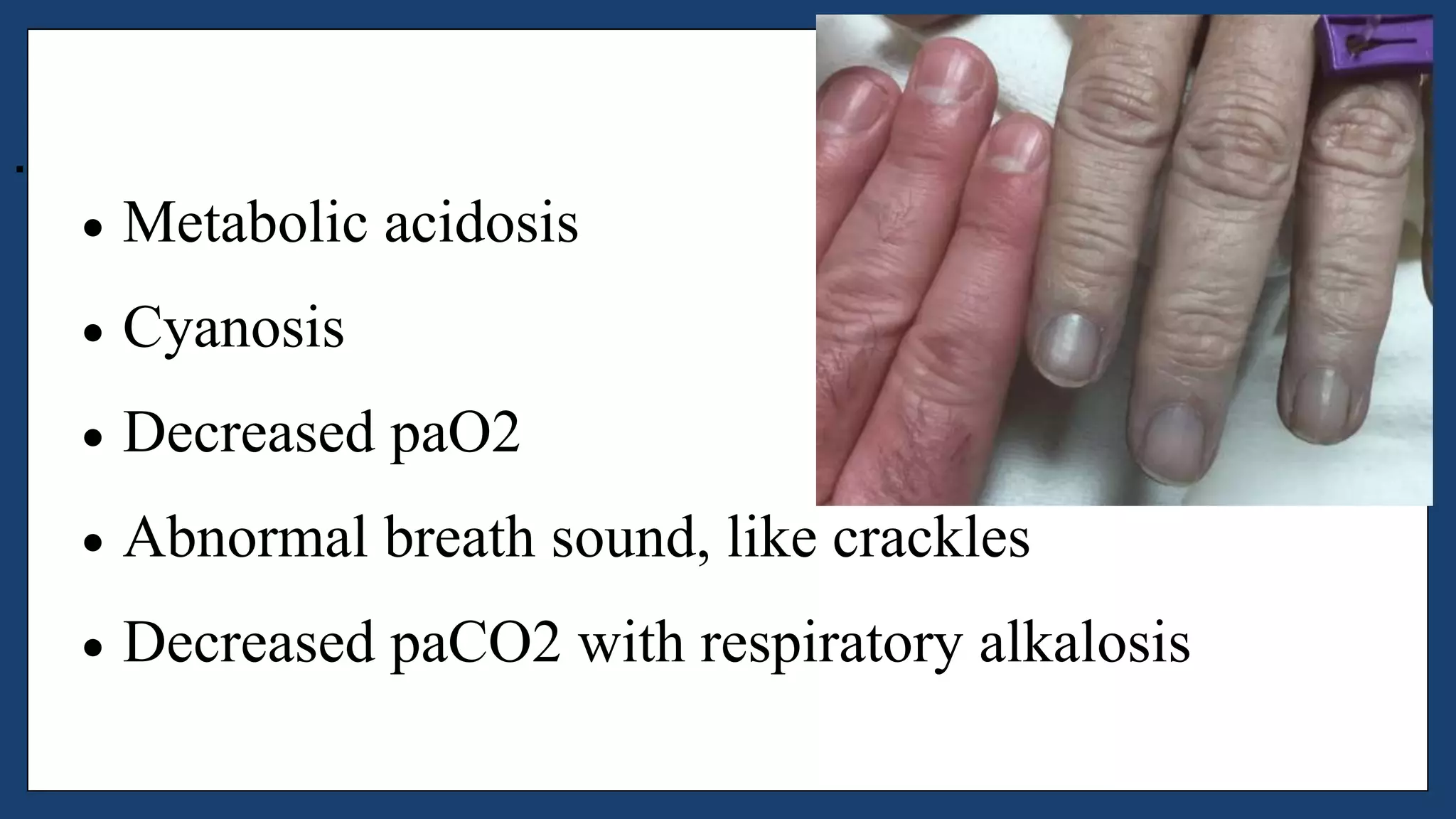 ARDS (acute respiratory distress syndrome) ppt SlideShare | PPTX