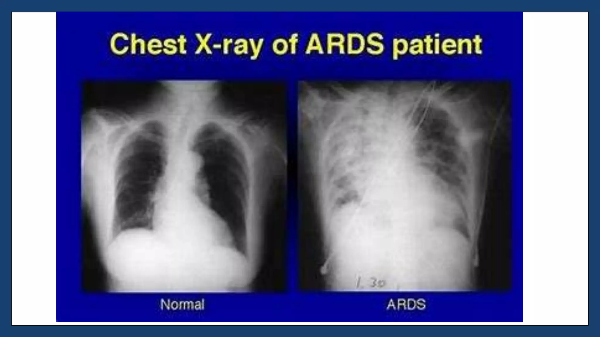 ARDS (acute respiratory distress syndrome) ppt SlideShare | PPTX