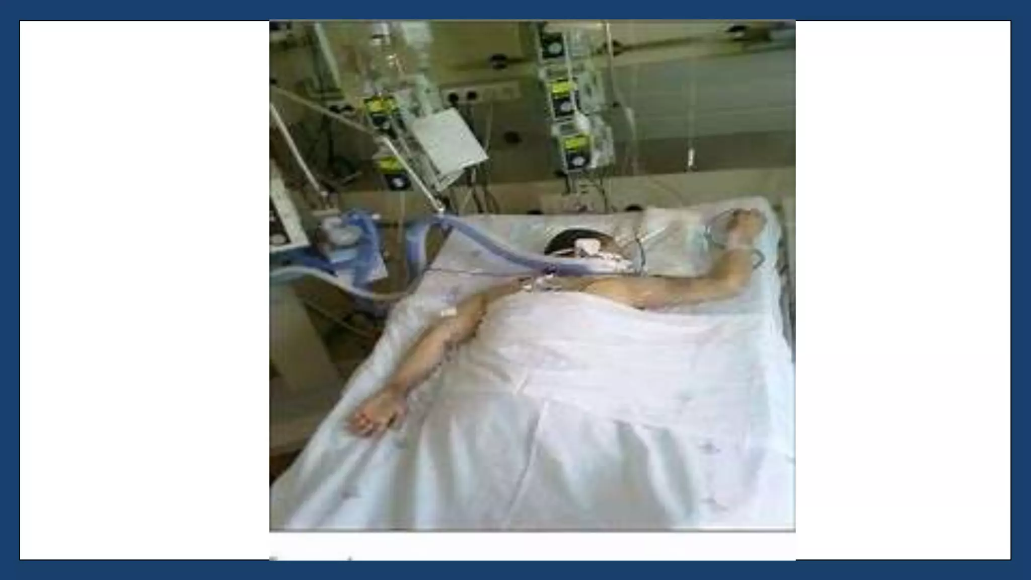 ARDS (acute respiratory distress syndrome) ppt SlideShare | PPTX