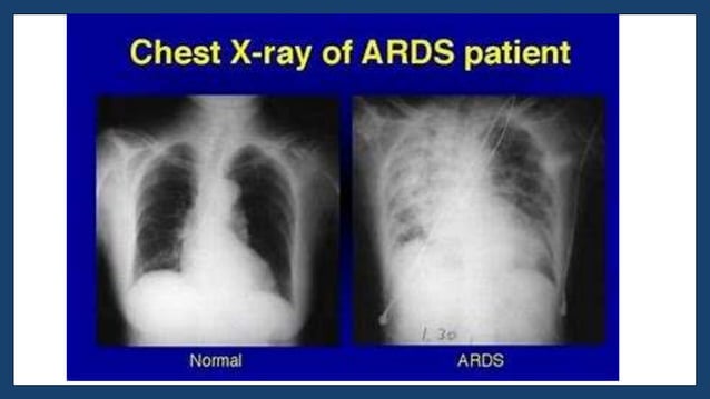 ARDS (acute respiratory distress syndrome) ppt SlideShare | PPTX