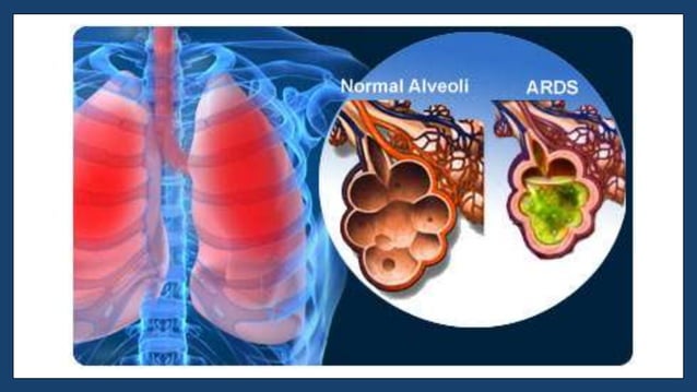 ARDS (acute respiratory distress syndrome) ppt SlideShare | PPTX