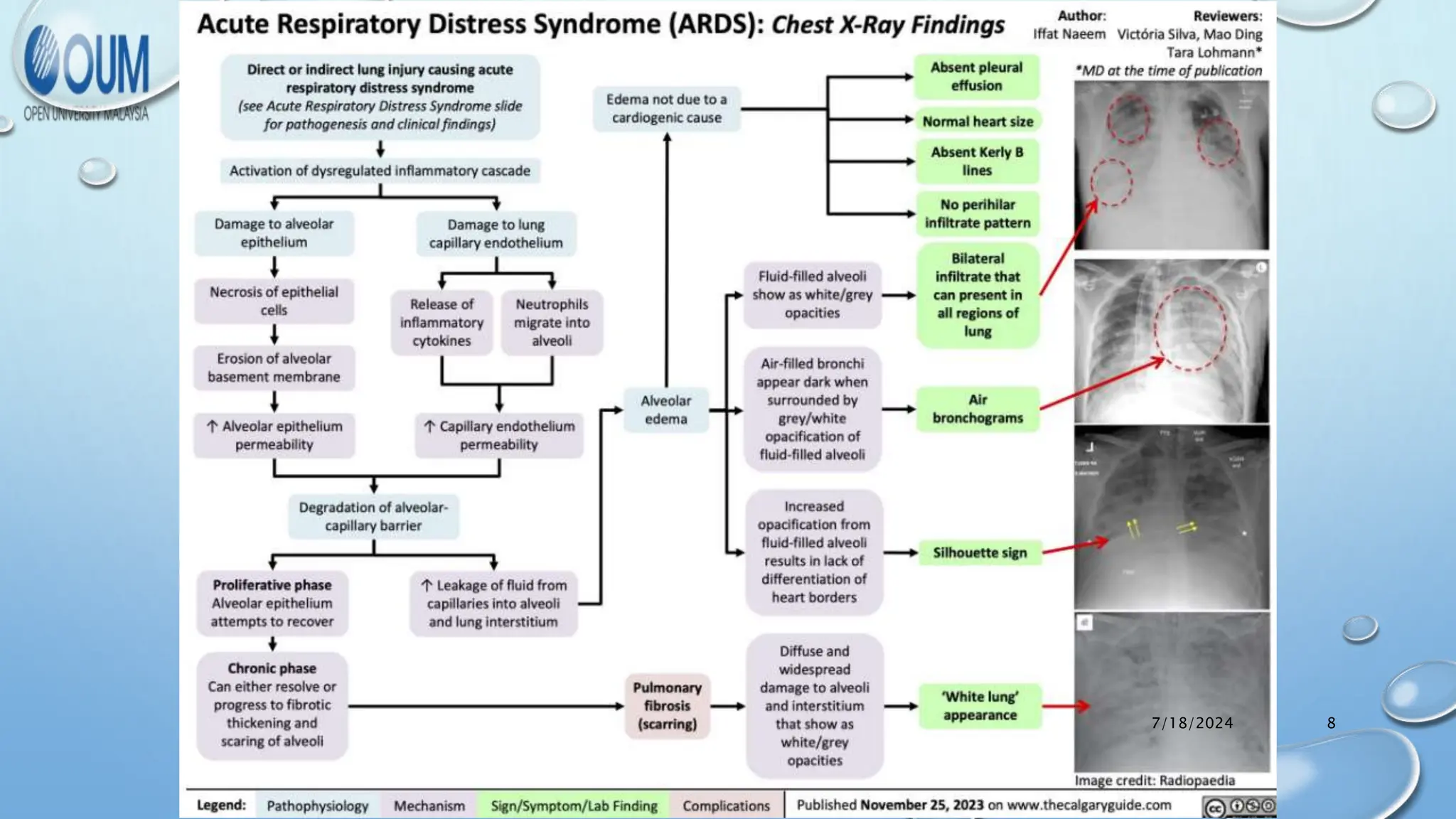 ARDS_Presentation.pptx acute respiratory disease syndrome | PPTX | Lung and Respiratory Health ...