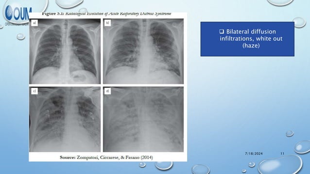 ARDS_Presentation.pptx acute respiratory disease syndrome | PPTX | Lung ...