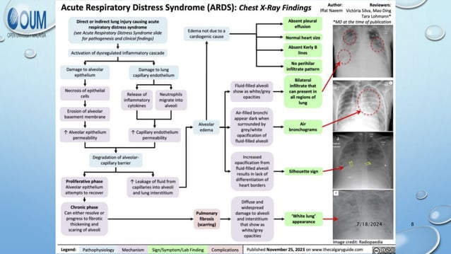 ARDS_Presentation.pptx acute respiratory disease syndrome | PPTX | Lung ...