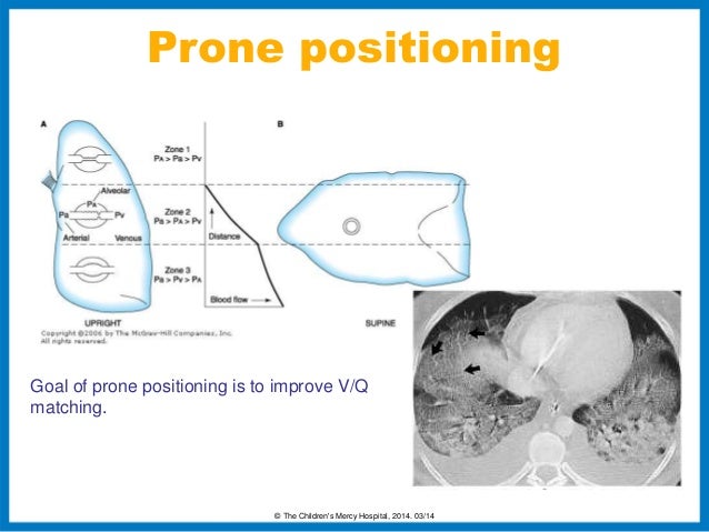 Prone Position Ards Prone Position For Children With COVID19