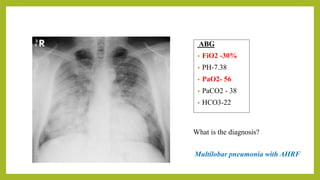 VENTILATORY STRATEGY IN ARDS CHANDAN.pdf
