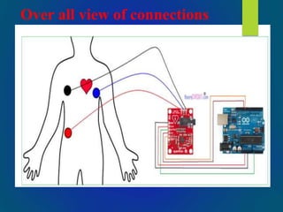 REAL TIME MONITORING OF ELCTRO CARDIC SIGNALS USING ARDUINO | PPTX