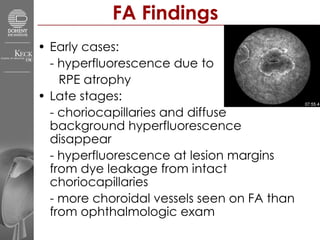 Areolar Dystrophy | PPT