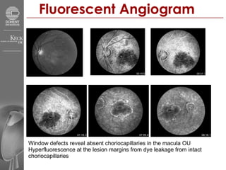 Areolar Dystrophy | PPT