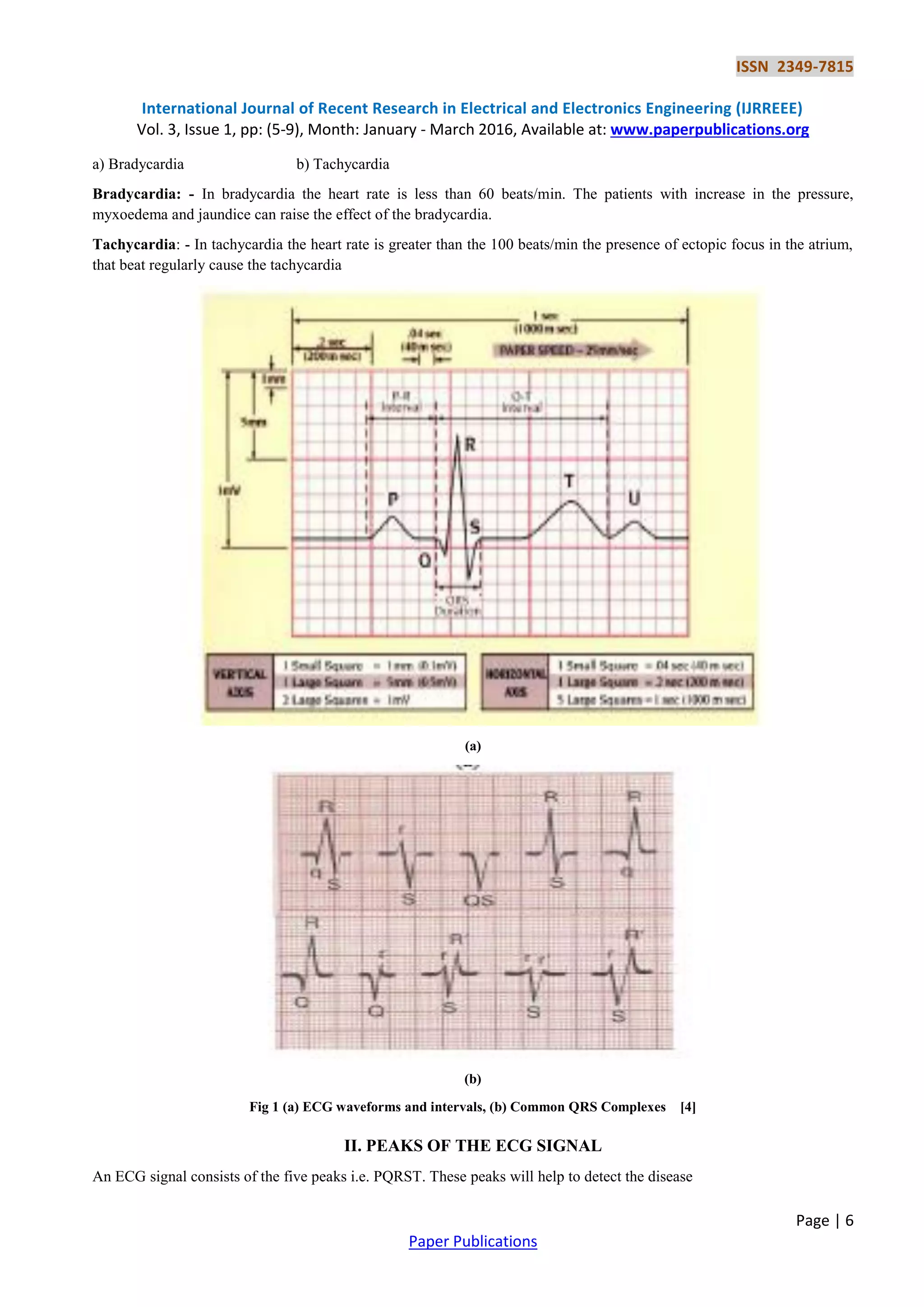 A Review On Arrhythmia Detection Using Ecg Signal Pdf