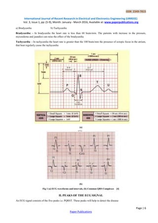 A Review on Arrhythmia Detection Using ECG Signal | PDF