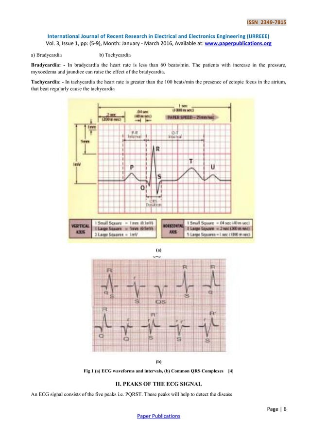 A Review on Arrhythmia Detection Using ECG Signal | PDF