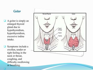 A Review on Thyroid Diseases | PPTX