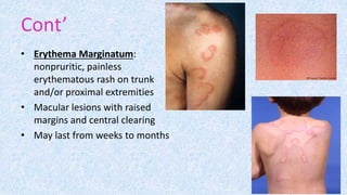 Acute Rheumatic Fever | PPT