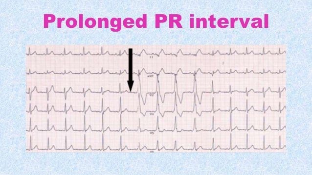 Acute Rheumatic Fever