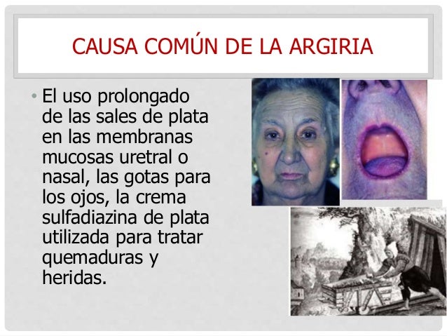 Enfermedad de la Argiria