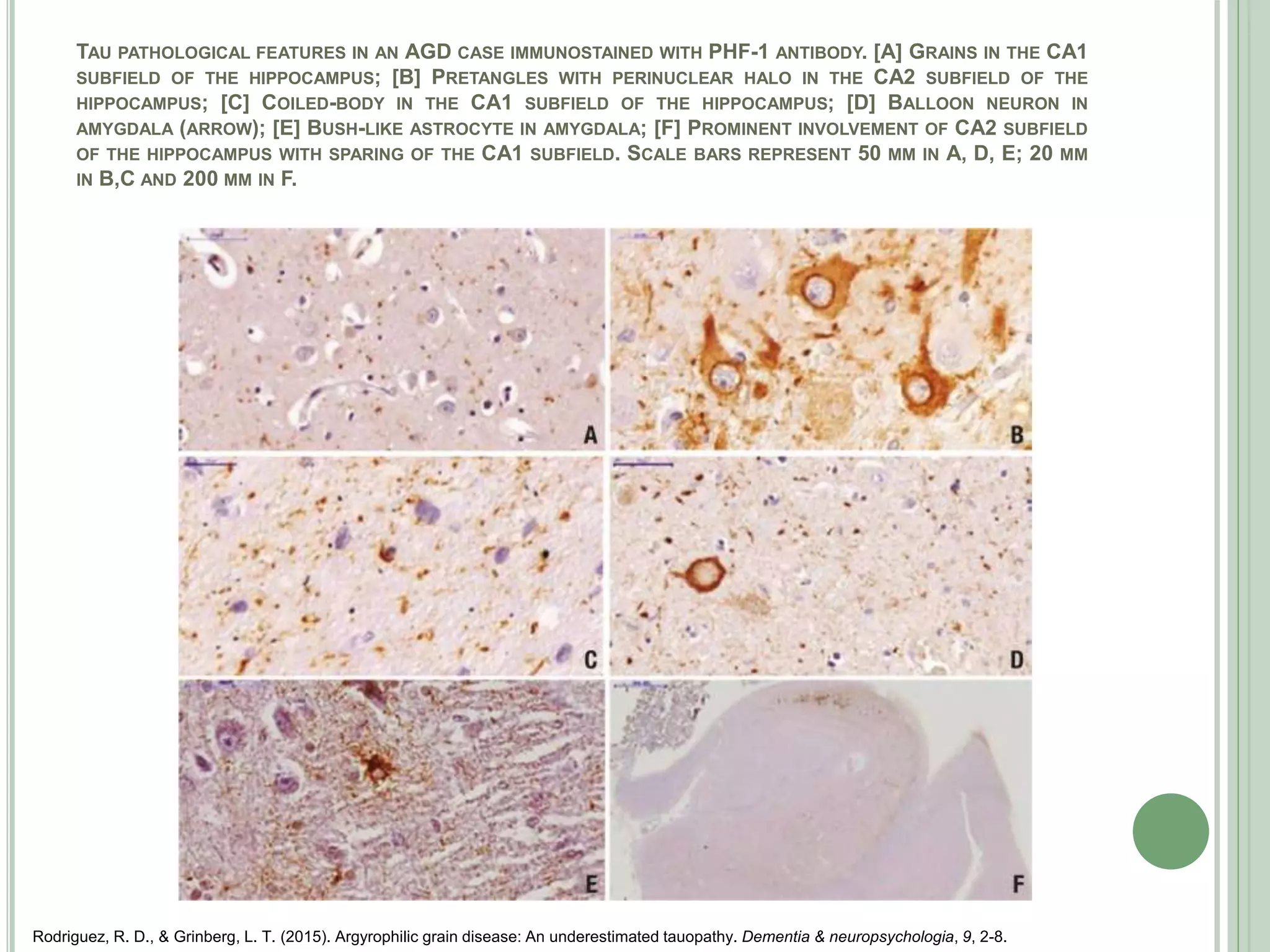Argyrophilic Grain Disease.pptx