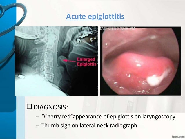 Acute respiratory infection (ARI)