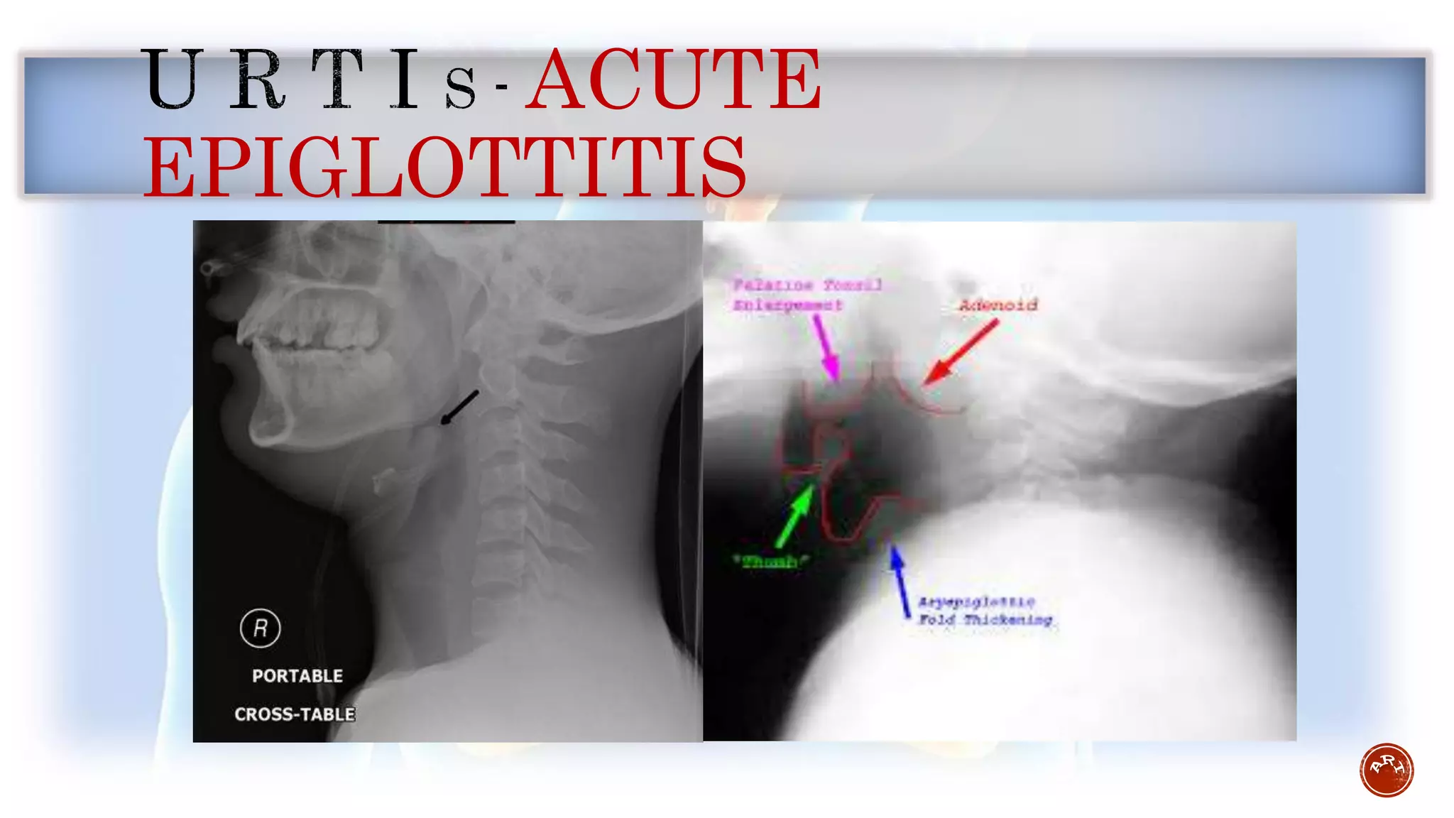 Acute Respiratory Infections - for UGs | PPTX