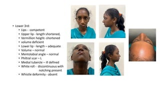 ARIKA - case of cleft lip and apalate and management | PDF