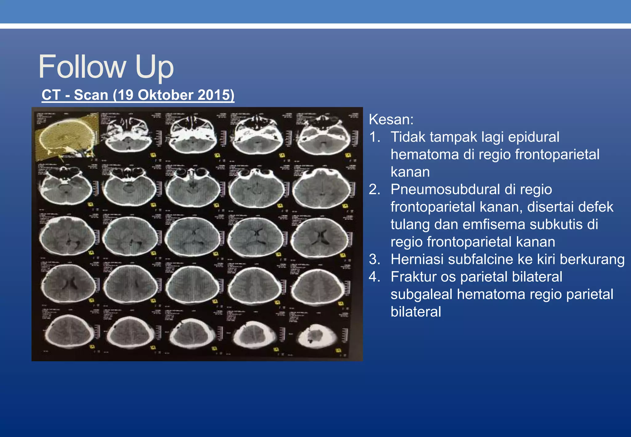 Trauma Kapitis / Cedera Kepala Berat | PPTX