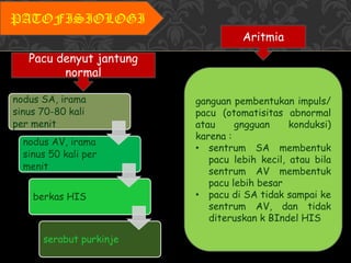 Aritmia | PPTX