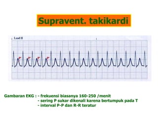 aritmia.ppt