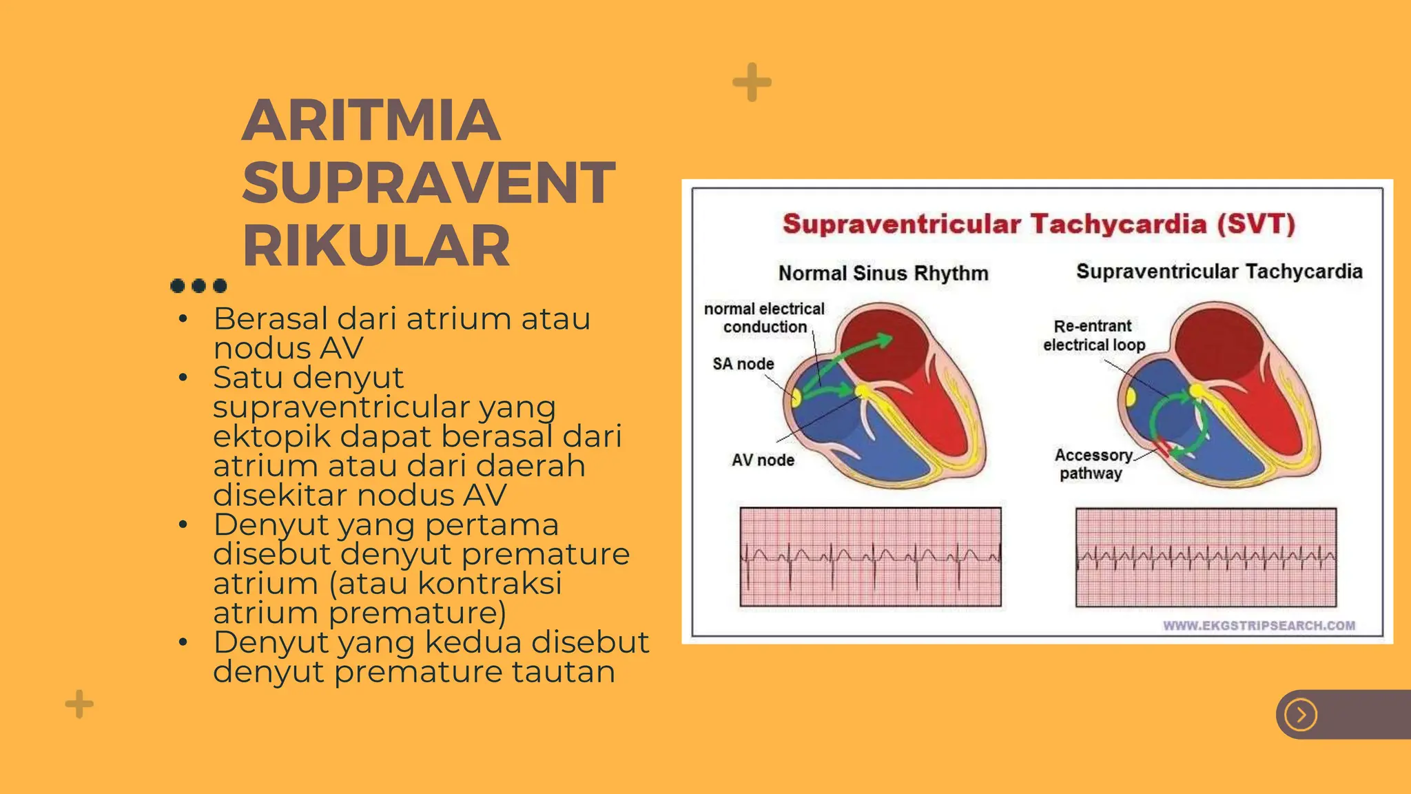 Aritmia pengertian pencegahan tatalaksana.pptx