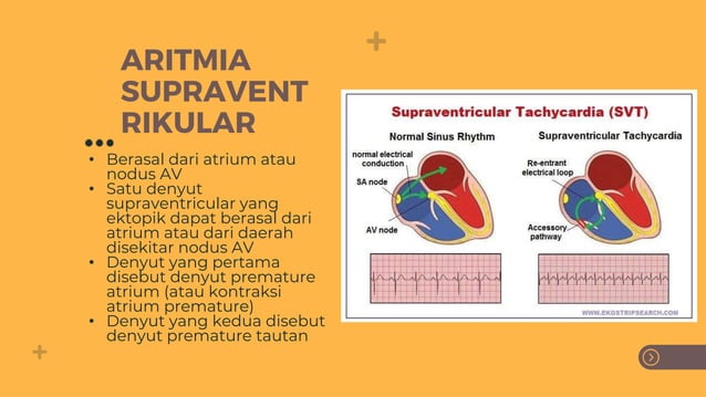 Aritmia pengertian pencegahan tatalaksana.pptx