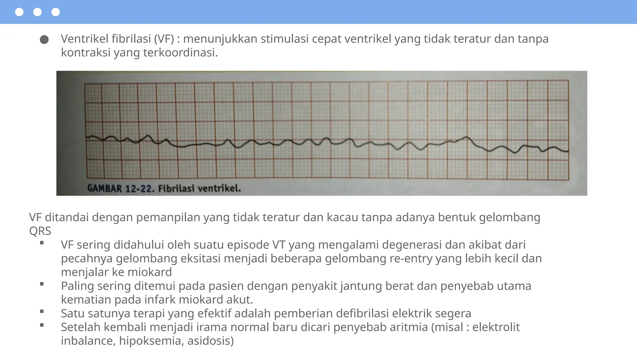 pengertian dan tatalaksana pada Aritmia .pptx