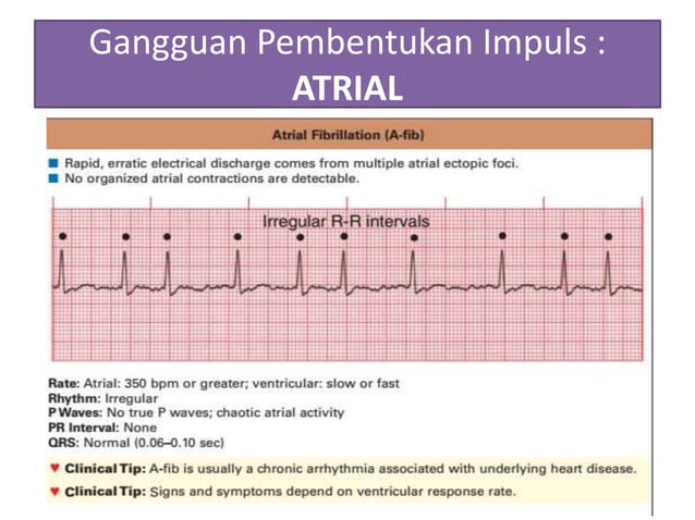 ARITMIA dan EKG PATOLOGIS.pptx