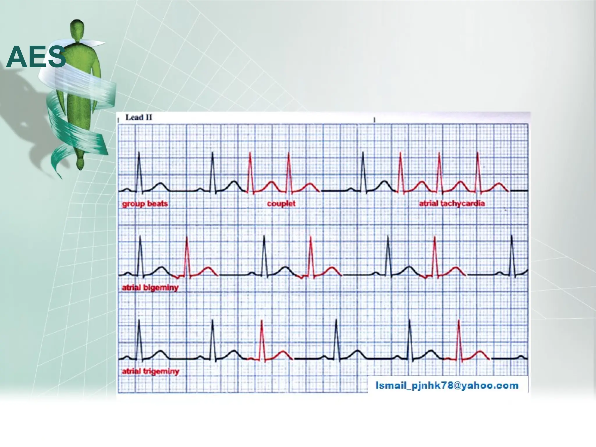 Gambaran EKG dengan Aritmia ggn pembentukan p3.ppt