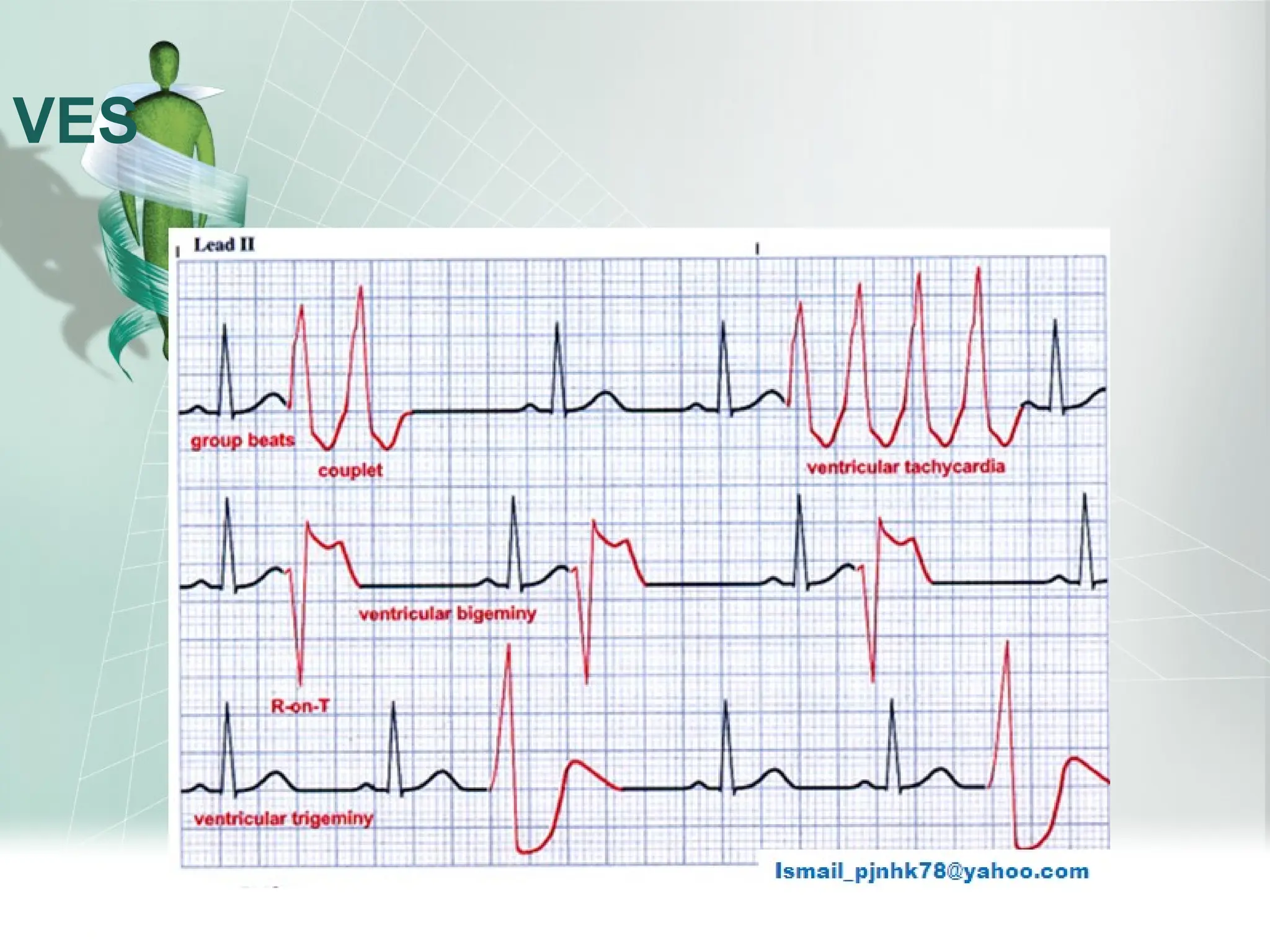 Gambaran EKG dengan Aritmia ggn pembentukan p3.ppt