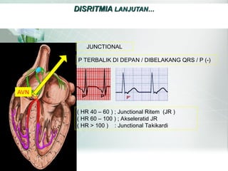 Gambaran EKG dengan Aritmia ggn pembentukan p3.ppt