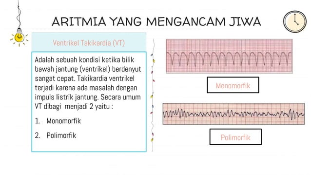 Aritmia Kelompok 2.pptx
