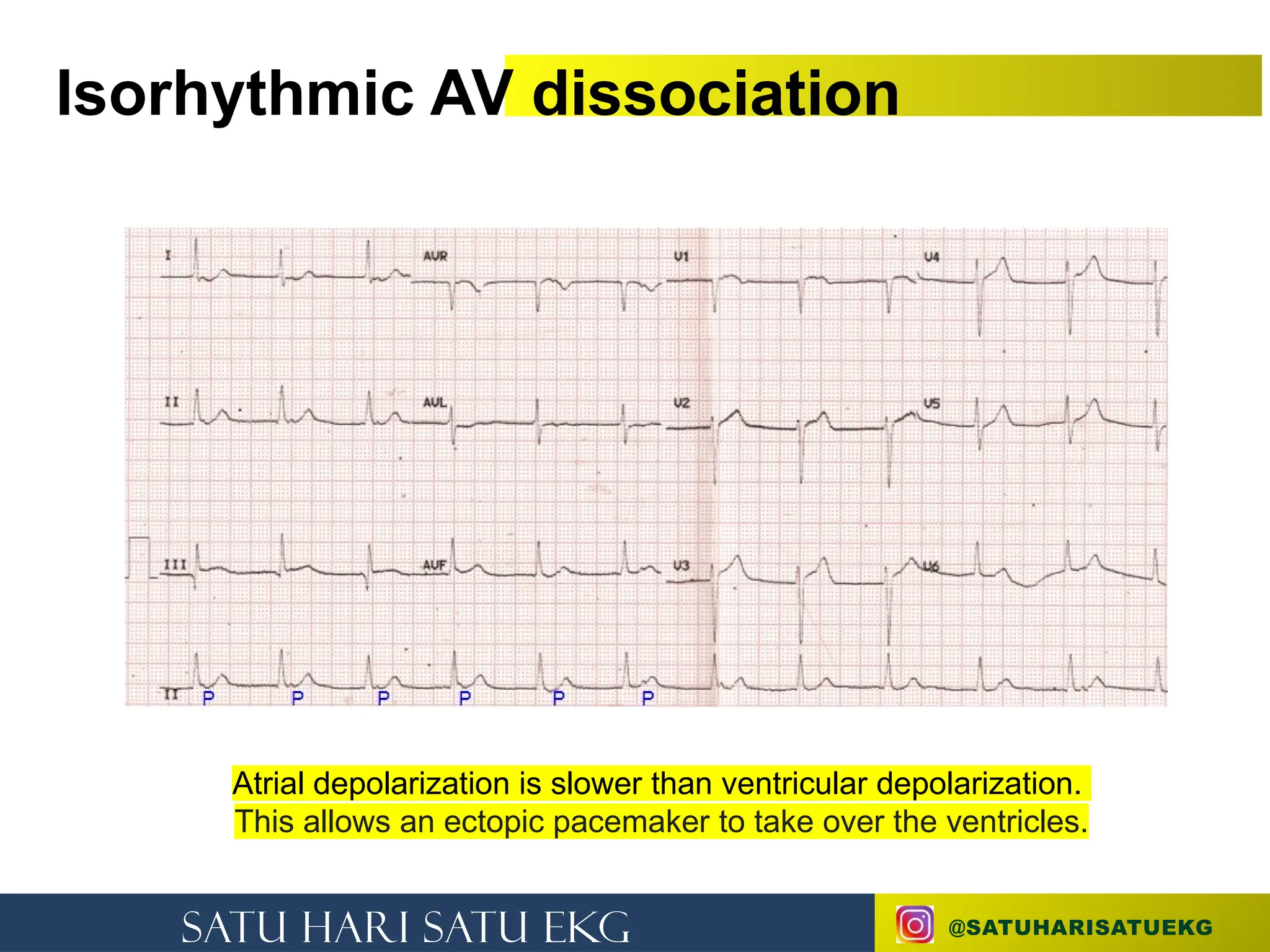 Aritmia Secara Umum. Sebuah Penjelasan Singkat .pptx