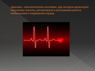 Aritmii | PPTX