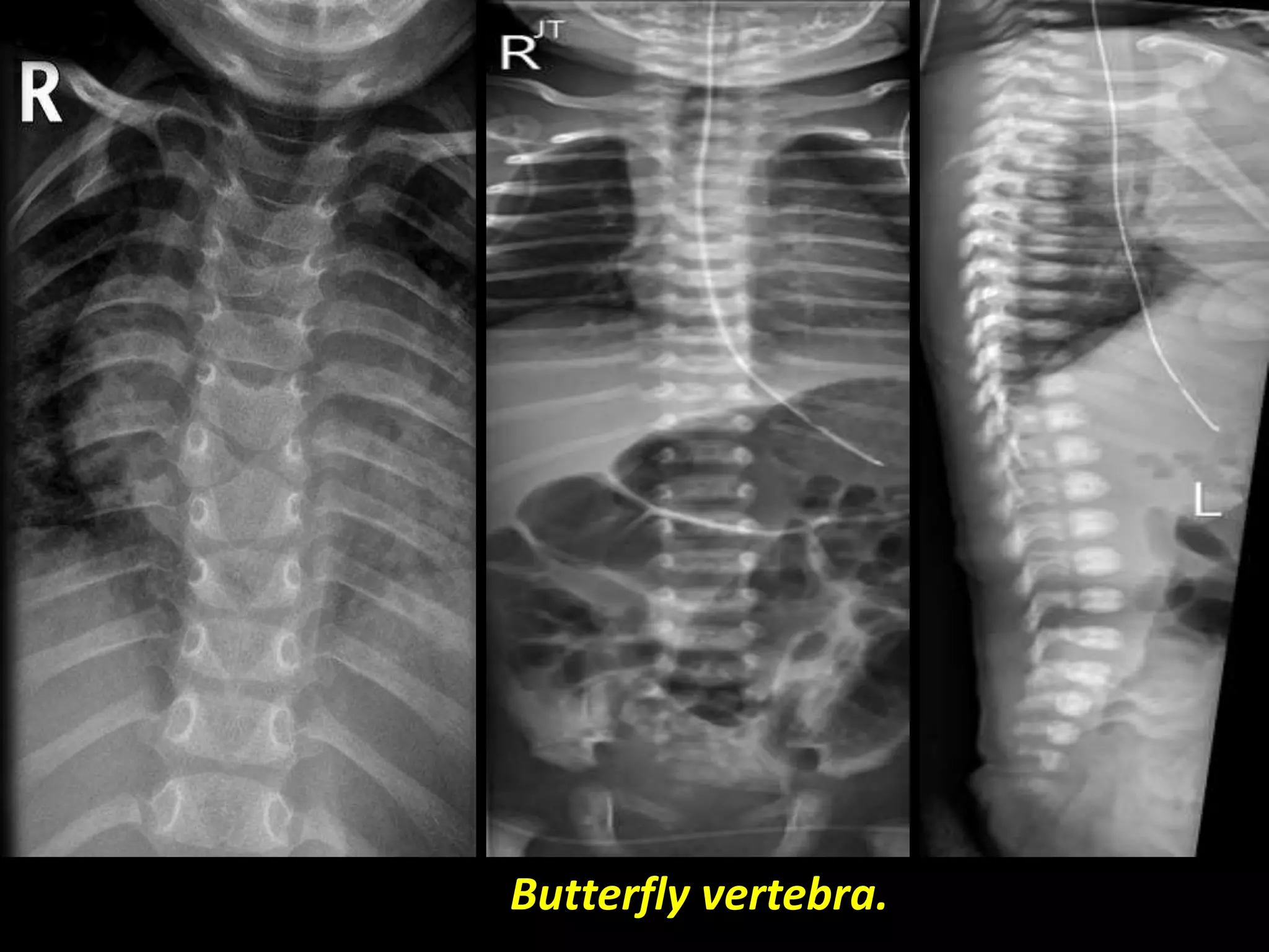 Ariunaa congenital spine disorders | PPTX