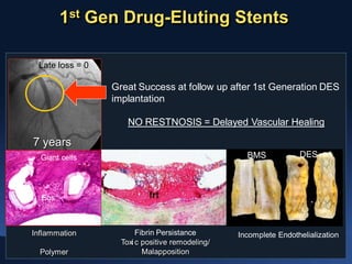 Bare Metal Stents | PPT
