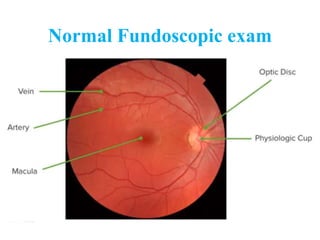 Age-related Macular Degeneration | PPTX
