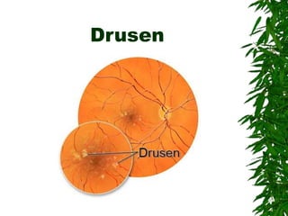 Low Vision Managment, Age Related Macular Degeneration ARMD | PPT