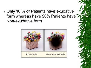 Low Vision Managment, Age Related Macular Degeneration ARMD | PPT